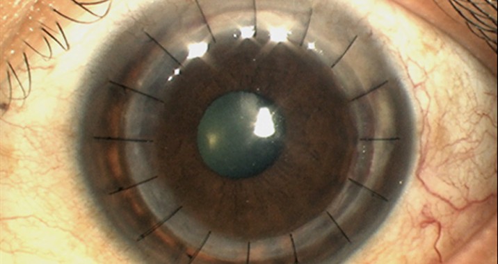 Corneal Surgery | Singapore Cornea Transplant | Eye & Cornea Surgeons