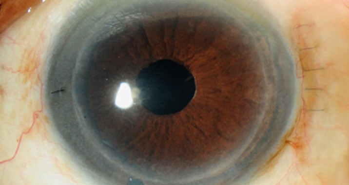 Corneal Surgery | Singapore Cornea Transplant | Eye & Cornea Surgeons