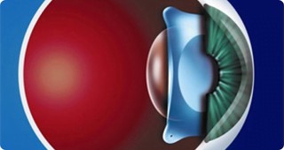 Vision Correction Surgery | Eye & Cornea Surgeons
